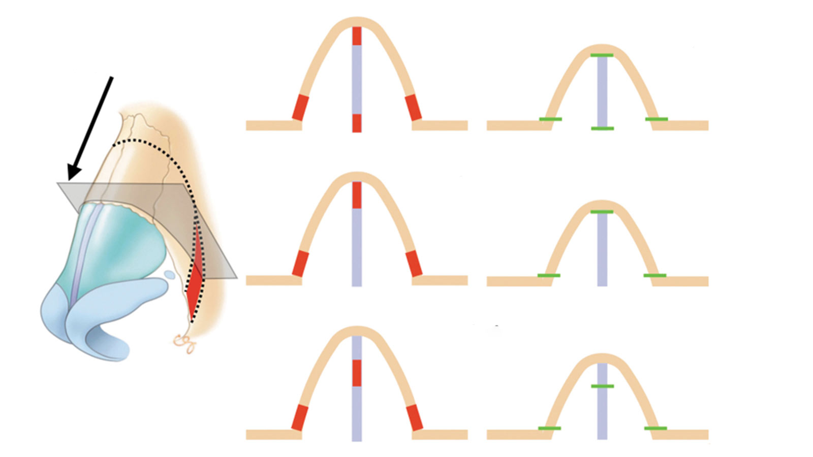 Fantasy Nose Surgery | Dr Benyamin Rahmati